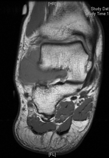 Synovial Sarcoma: Soft Tissue Sarcoma Synovial Sarcoma: Soft Tissue Sarcoma